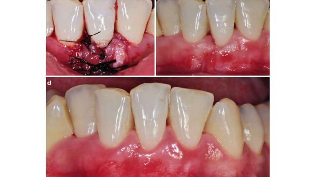 Laterally Positioned Flap VS Coronally Advanced Flap | PPTX | Dental ...