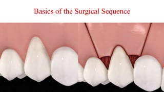 Laterally Positioned Flap VS Coronally Advanced Flap | PPTX | Dental ...