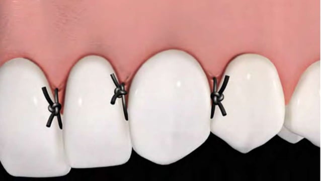 Laterally Positioned Flap VS Coronally Advanced Flap | PPTX | Dental ...