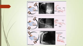 CAG interpretation Dr Shiva CTVS JIPMER | PPTX