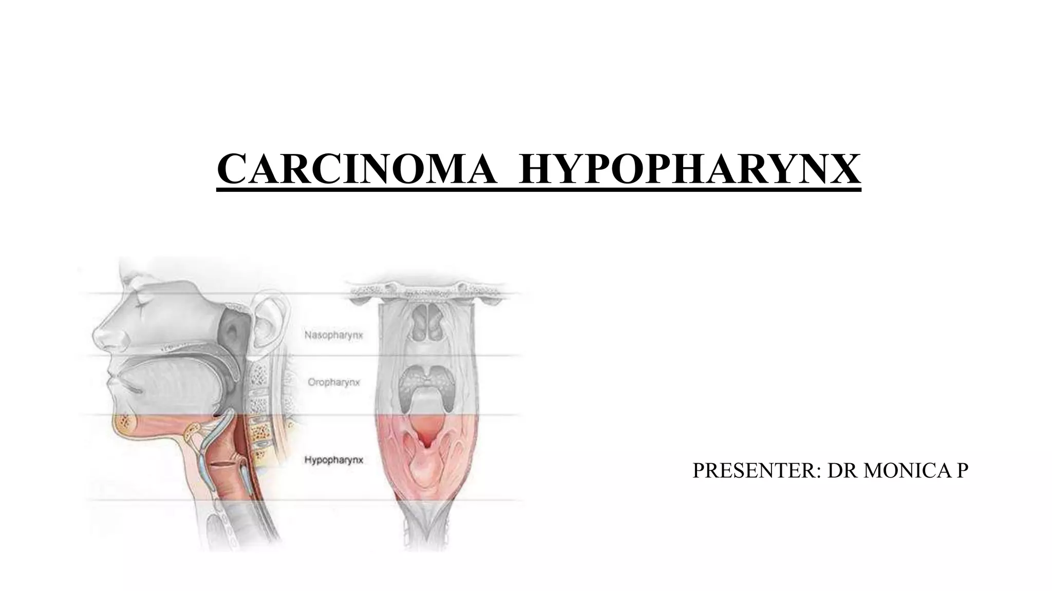 CA HYPOPHARYNX.pptx