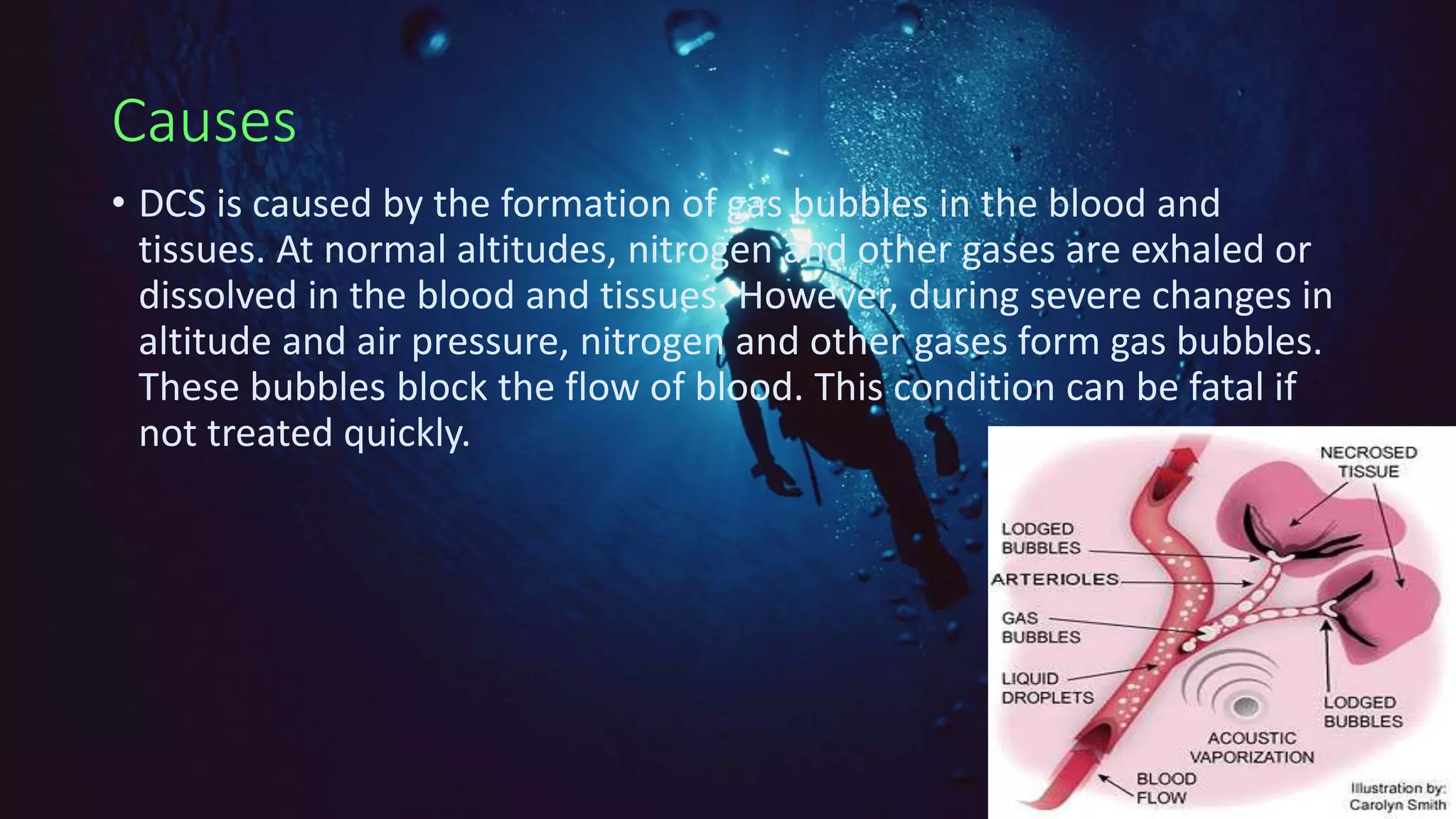 Caisson's disease | PPTX