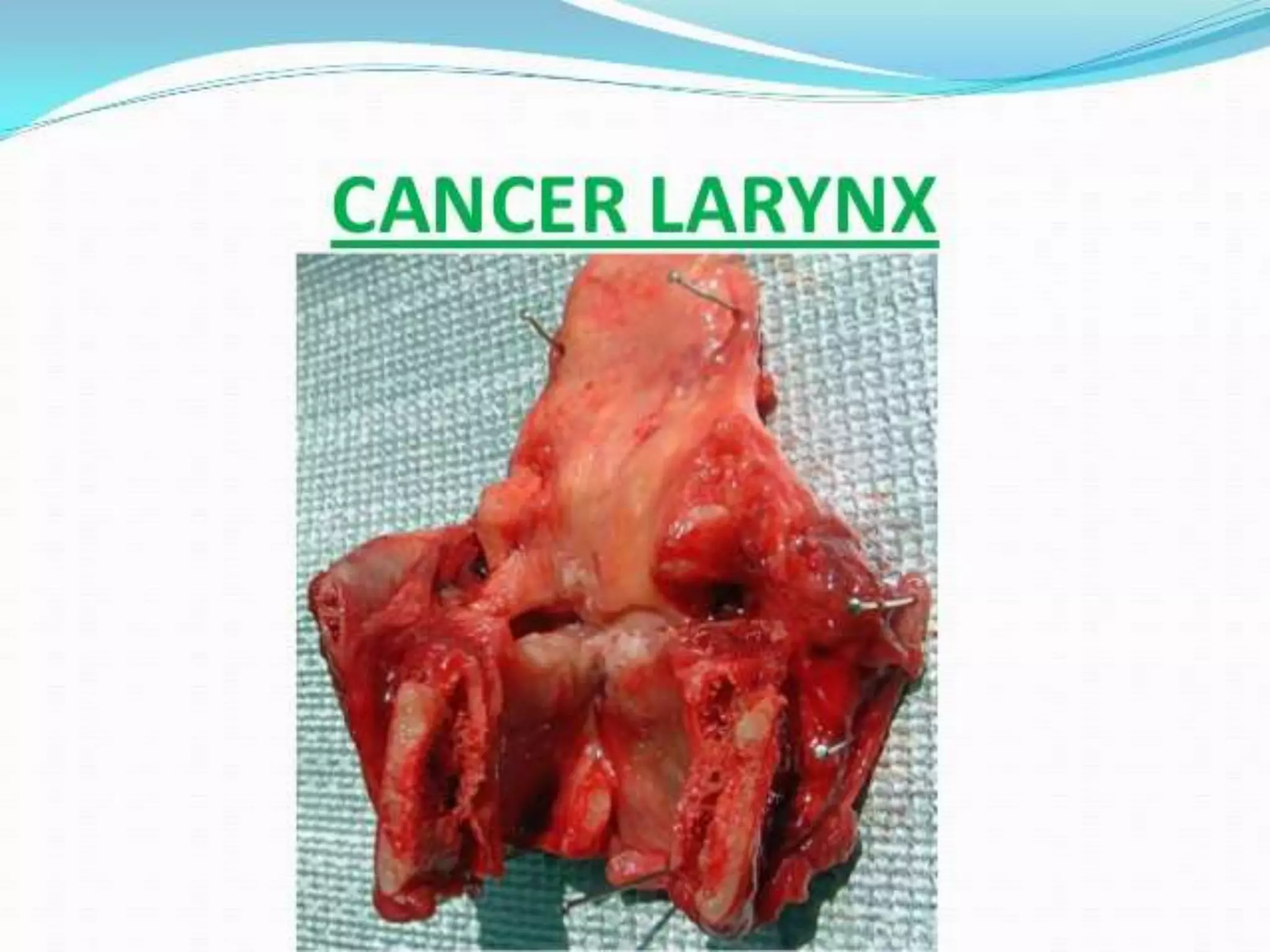 Ca larynx | PPTX