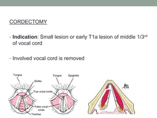 Ca larynx principles of management | PPTX