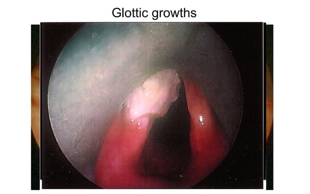 Ca larynx - etio & types | PPT