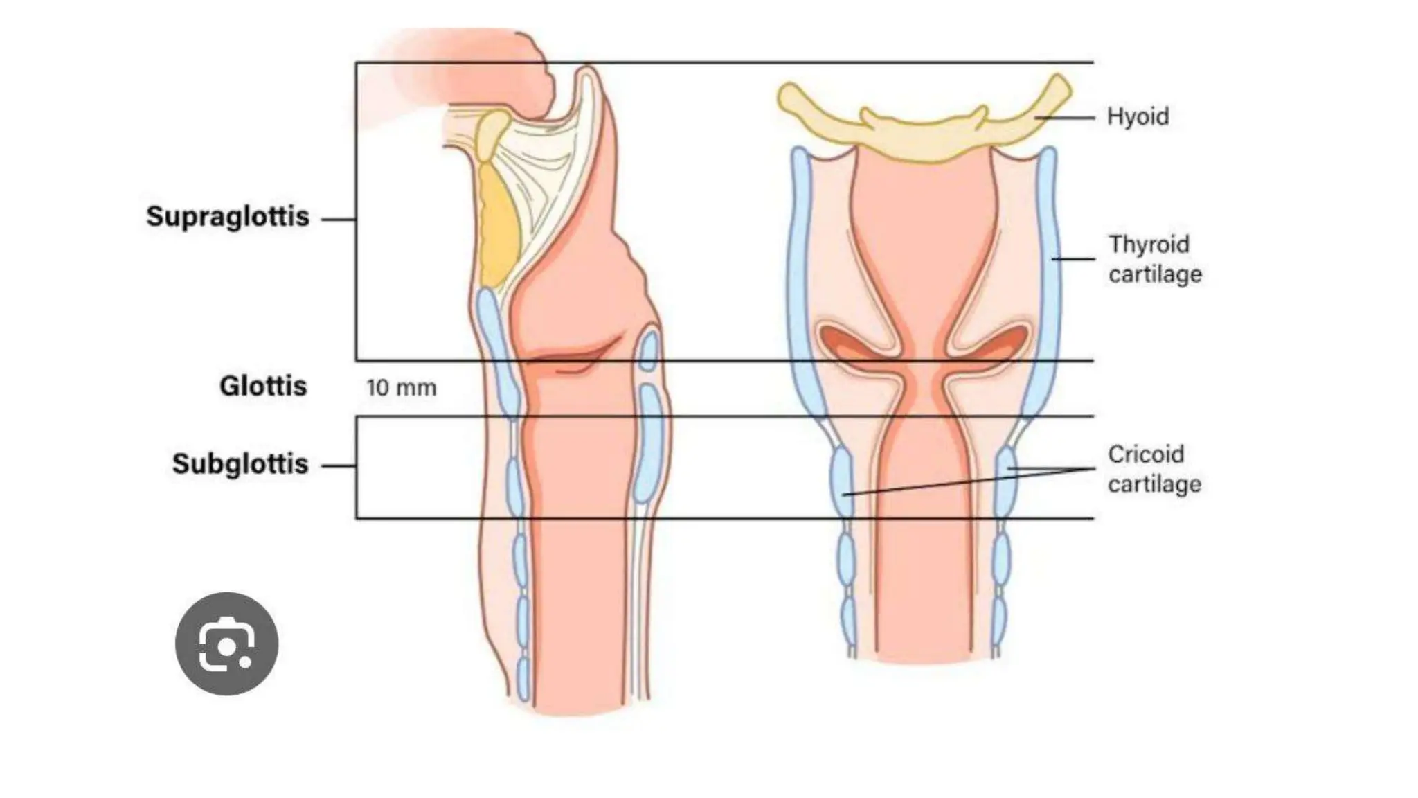 ca larynx continue (1) vrgrgefwdvferfq.pptx | Thyroid Disorders | Endocrine and Metabolic Diseases