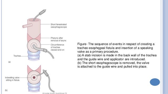 Ca larynx management