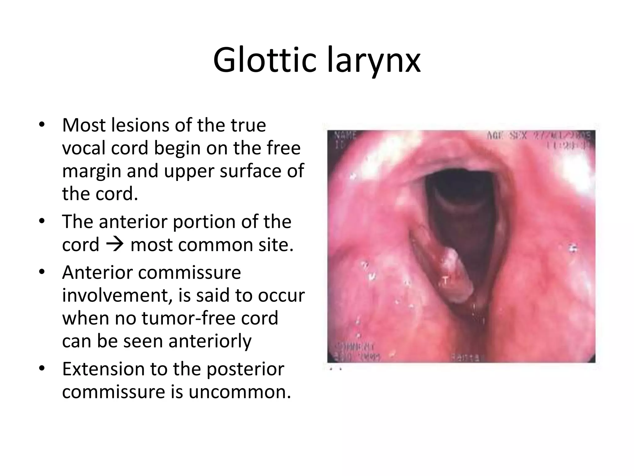 LARYNGEAL CANCER MANAGEMENT | PPTX