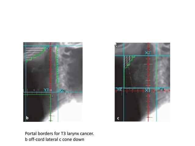 LARYNGEAL CANCER MANAGEMENT | PPTX | Ear, Nose and Throat Conditions ...