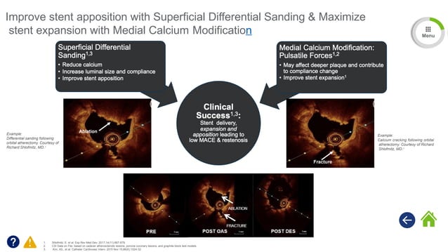 OCT guided PTCA in Calcifiedlesions .pptx