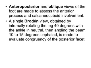 Calcaneal Fractures | PPT