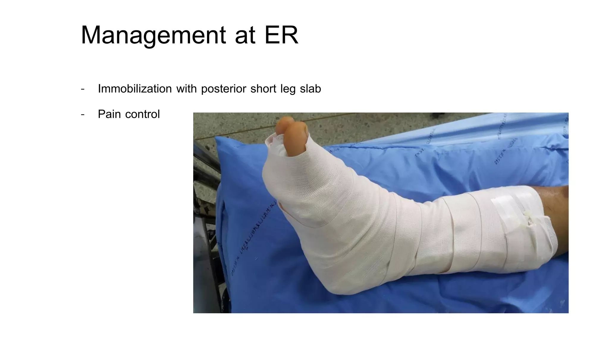 Calcaneal fracture | PDF