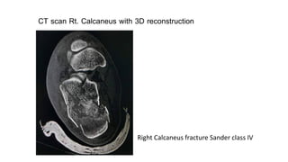 Calcaneal fracture | PDF