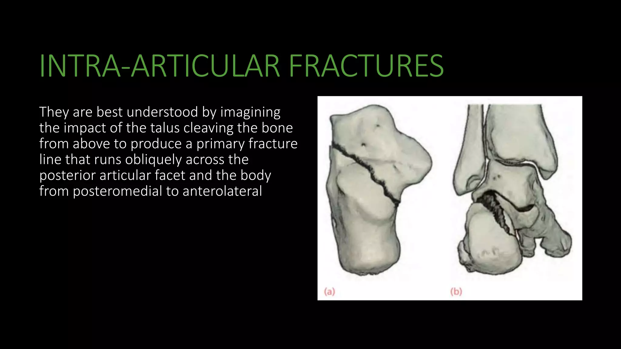 Calcaneal fracture | PPTX