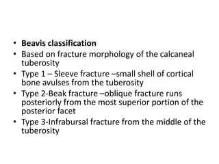 CALCANEAL FRACTURE AND ITS DETAILS WITH MALUNION | PPTX