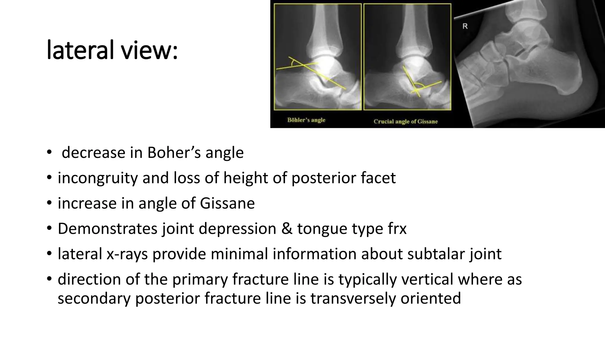 Calcaneal fracture 101 bedru mohammed15168tyr42.pptx