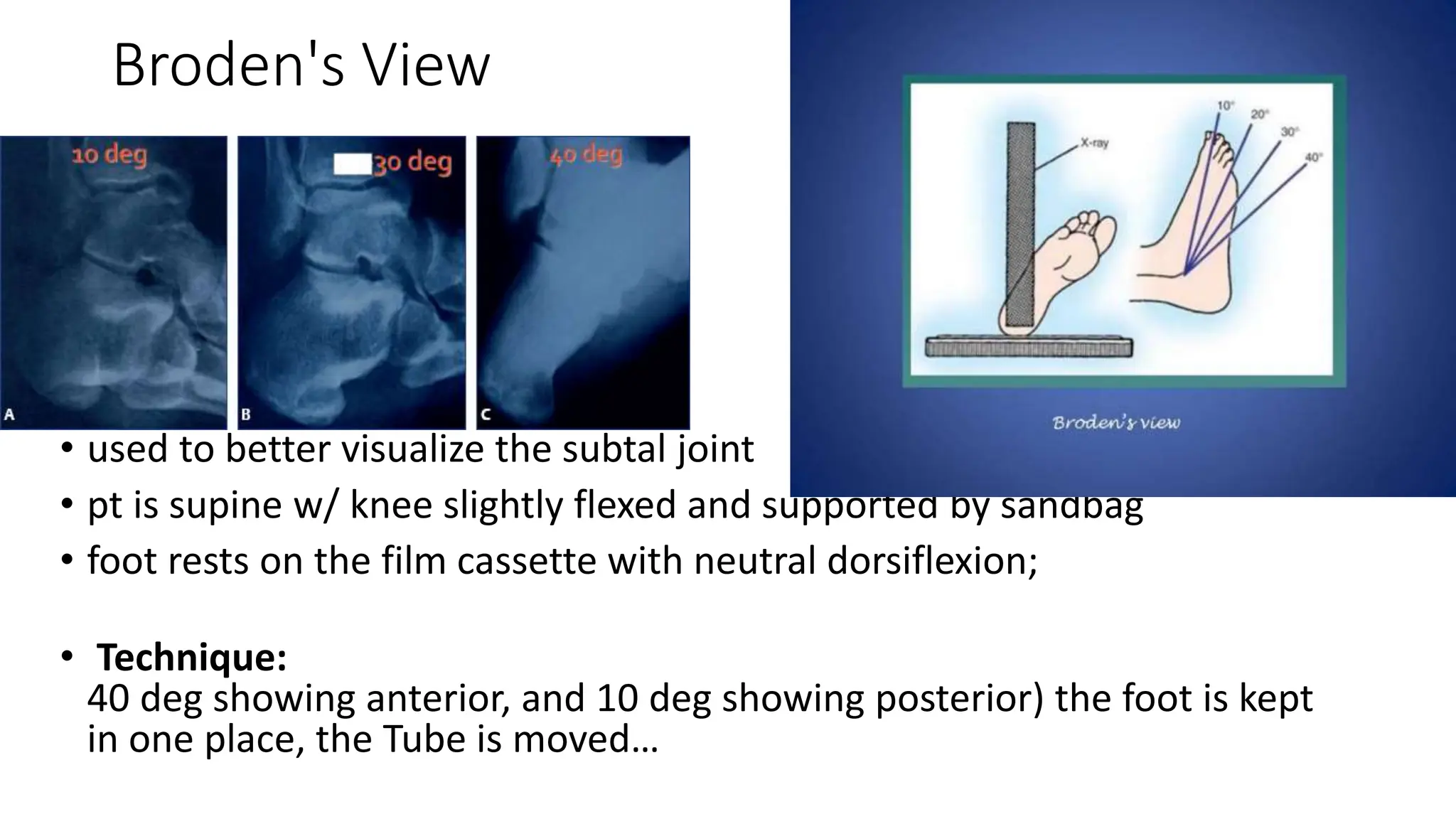 Calcaneal fracture 101 bedru mohammed15168tyr42.pptx