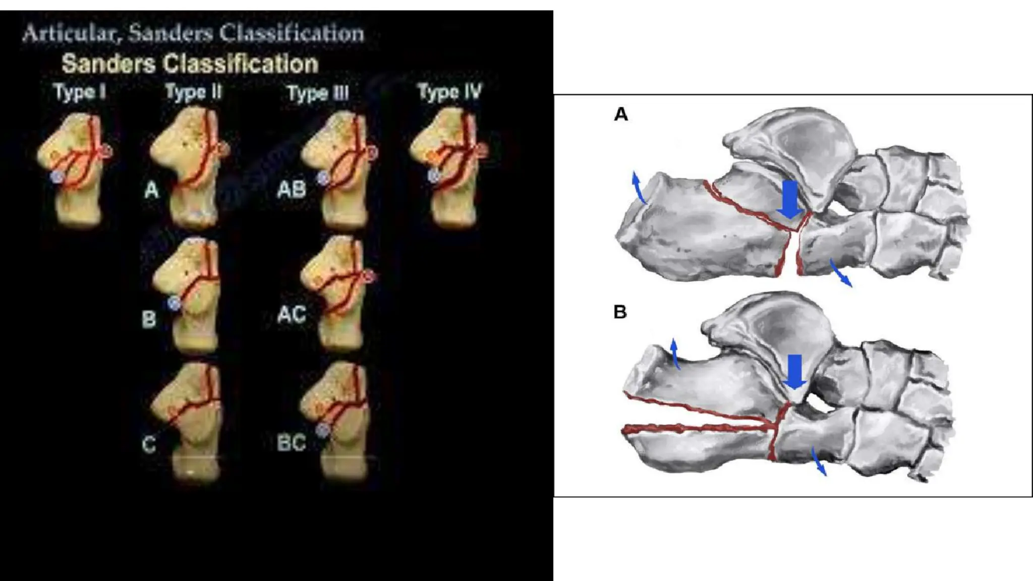 Calcaneal fracture 101 bedru mohammed15168tyr42.pptx