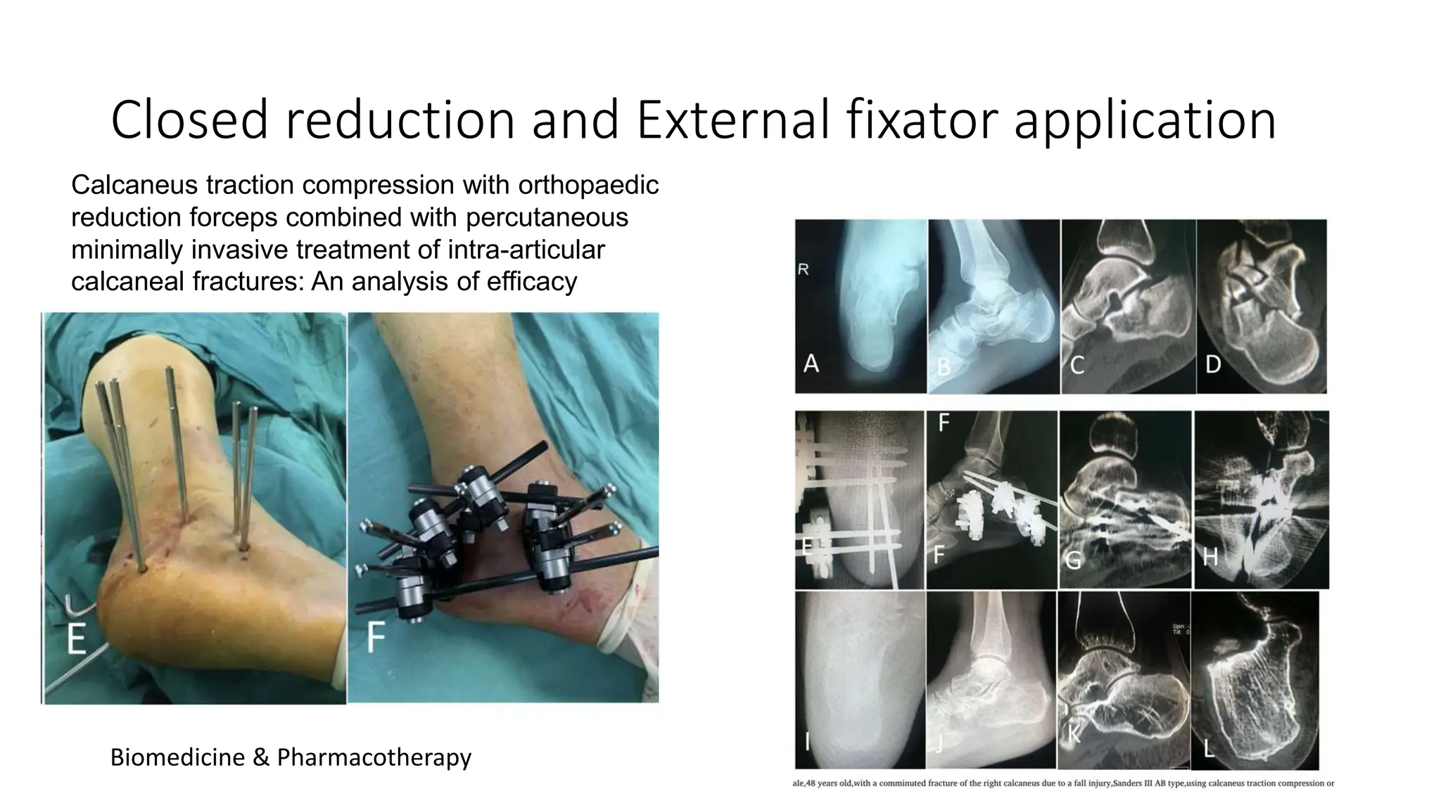 Calcaneal fracture 101 bedru mohammed15168tyr42.pptx