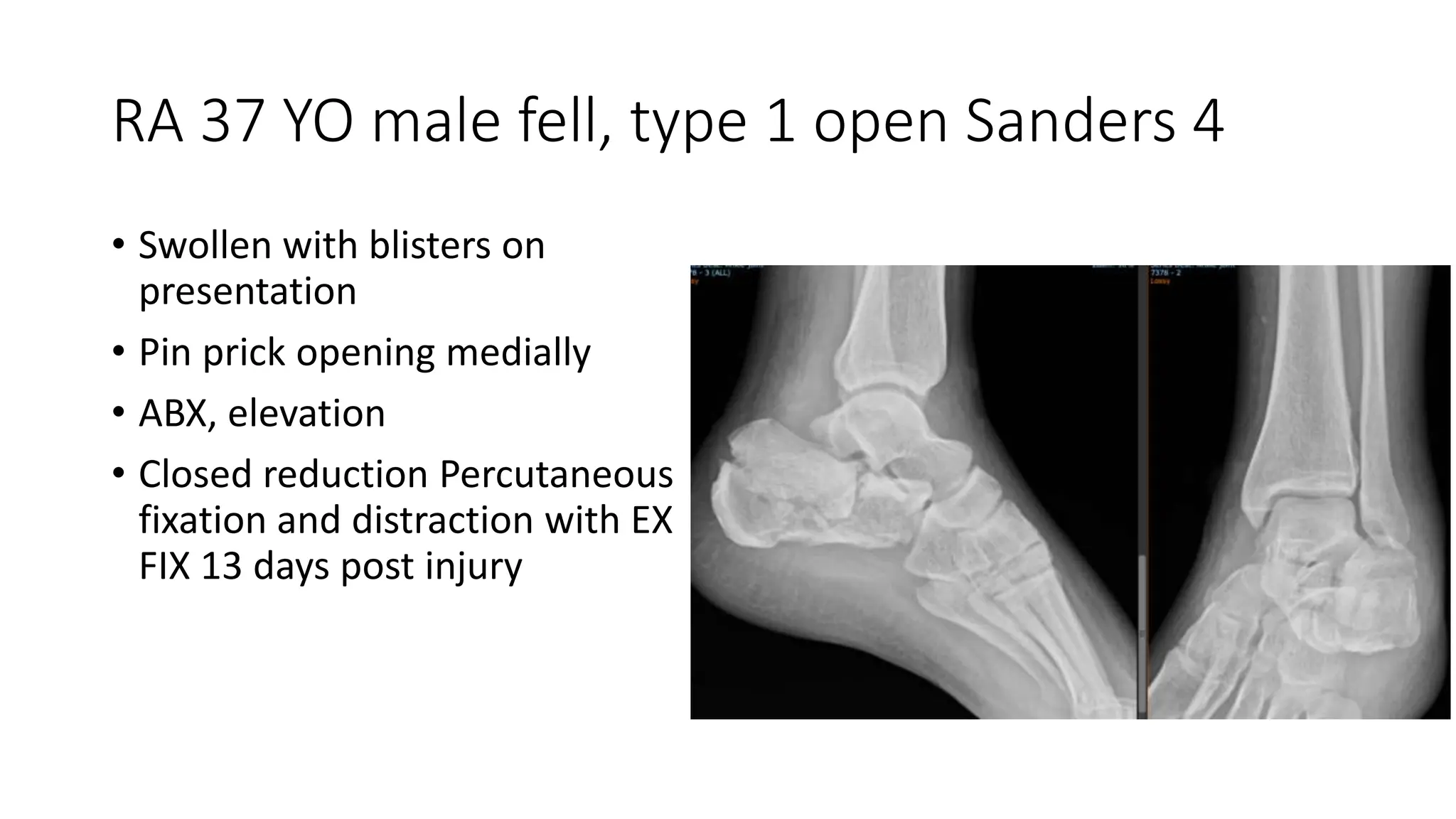 Calcaneal Fracture 101 Bedru Mohammed15168tyr42pptx