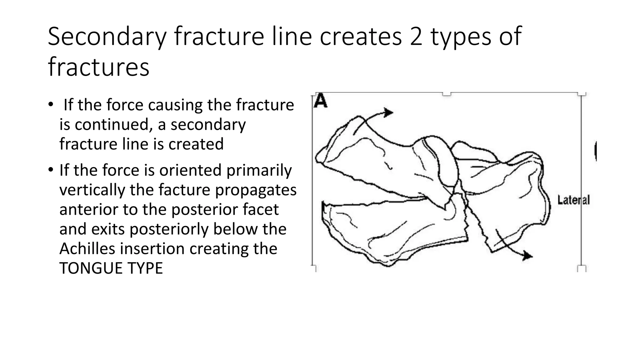 Calcaneal fracture 101 bedru mohammed15168tyr42.pptx