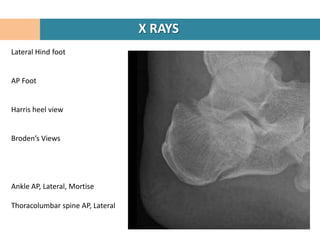 Calcaneal fractures | PPTX