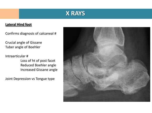 Calcaneal fractures | PPT