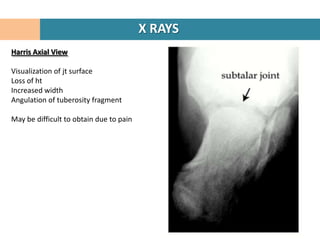 Calcaneus Fracture Axial View