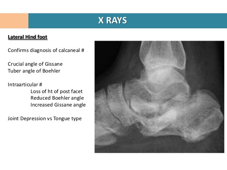 Calcaneal fractures