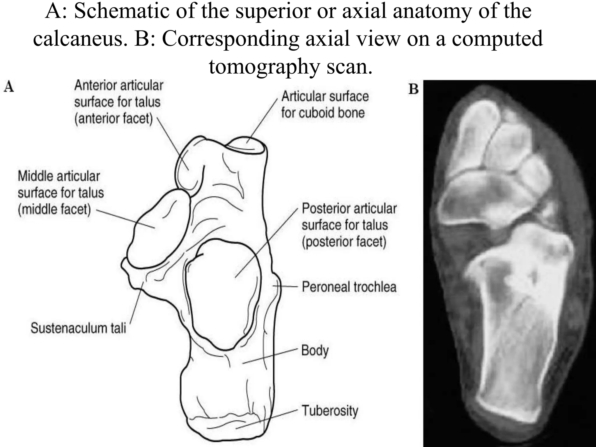 calcanealfractures-180405123703.pdf third year student | PPT