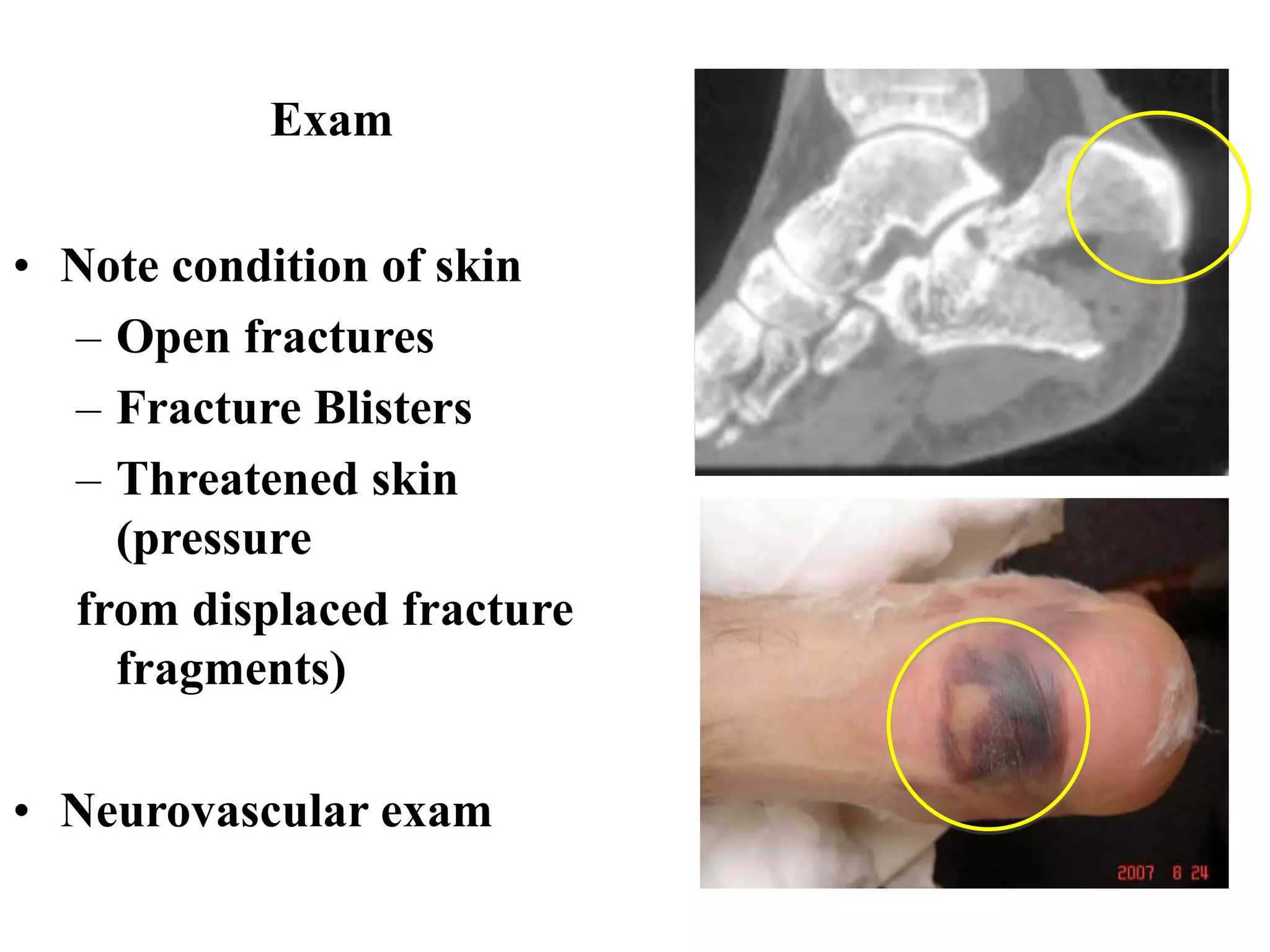 Calcaneal fractures | PPTX