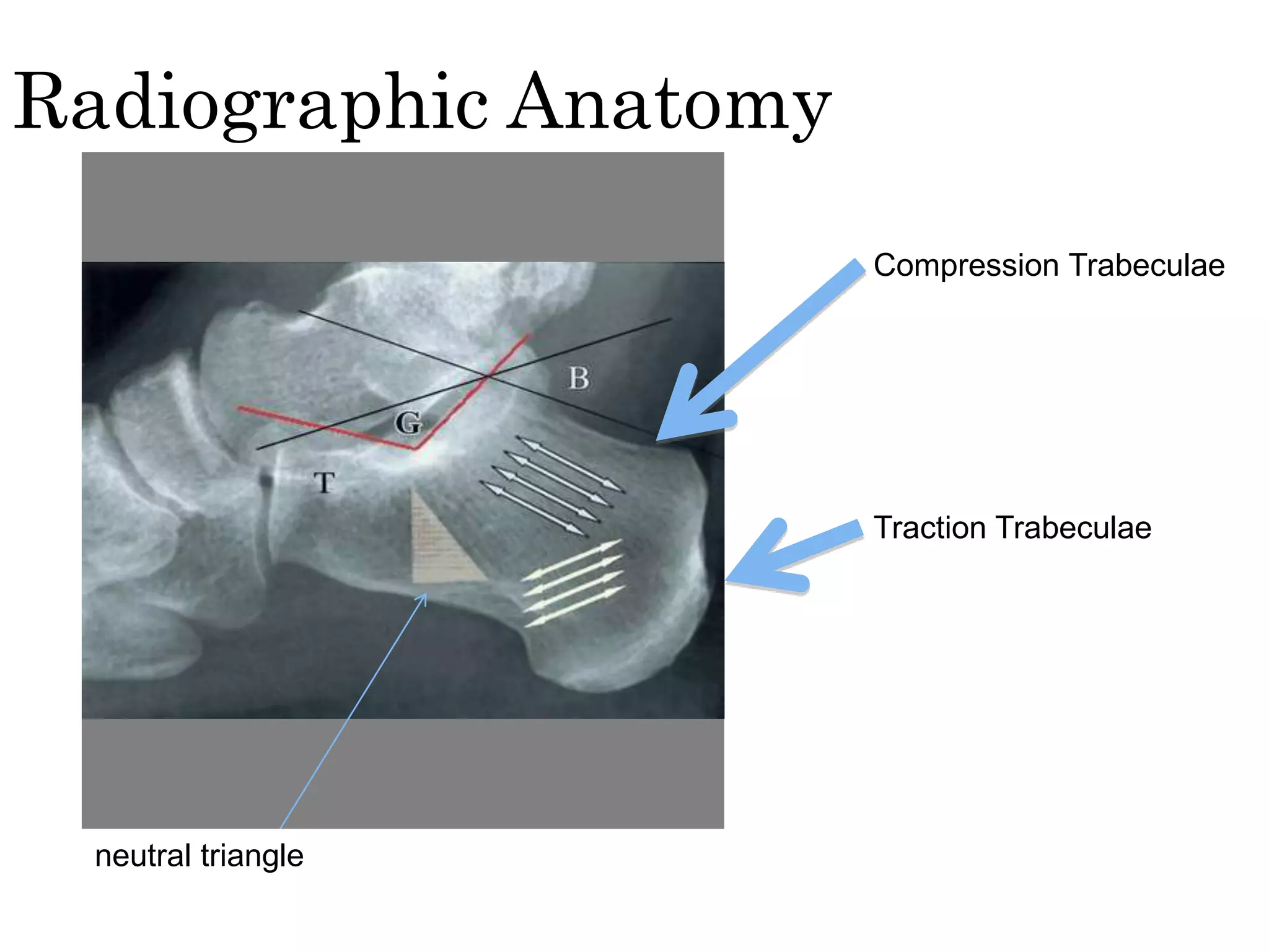 Calcaneal fractures | PPTX