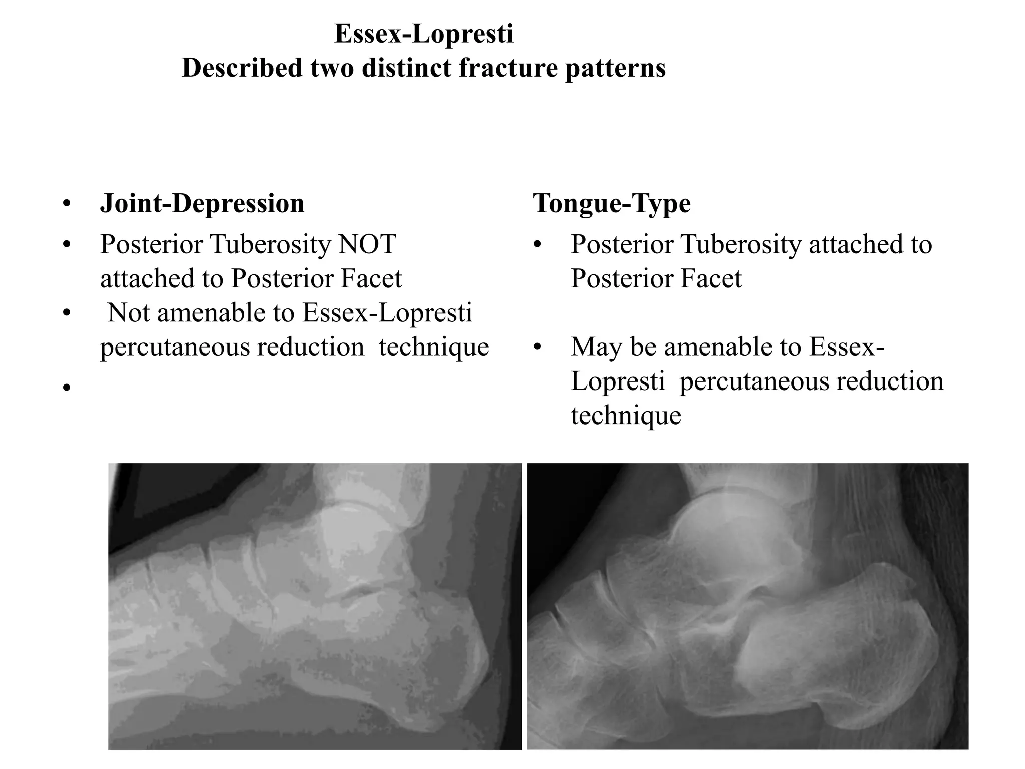 Calcaneal fractures | PPTX