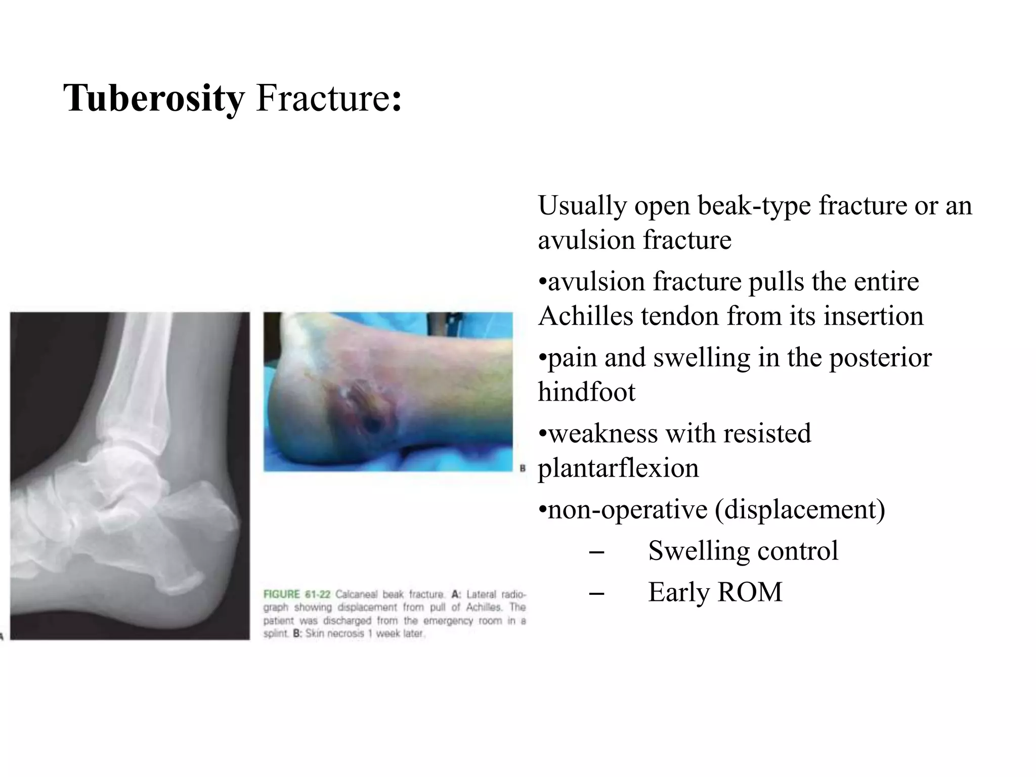 Calcaneal fractures | PPTX