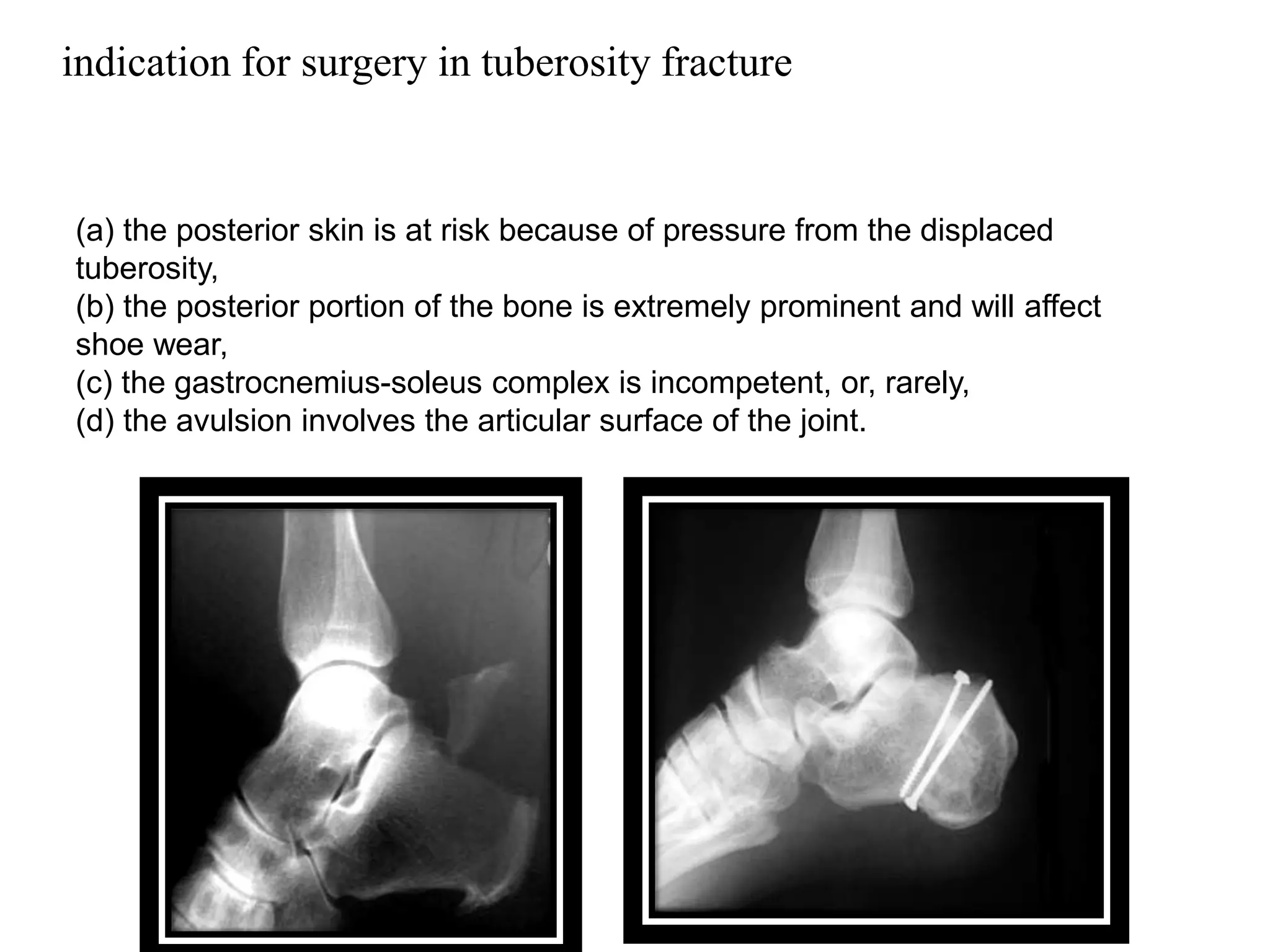 Calcaneal fractures | PPTX