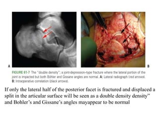 Calcaneal fractures | PPTX