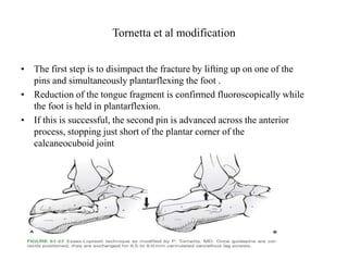Calcaneal fractures | PPTX