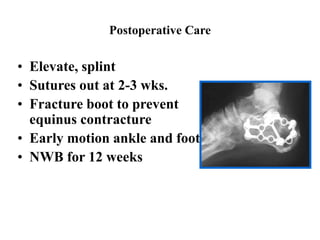 Calcaneal fractures | PPTX