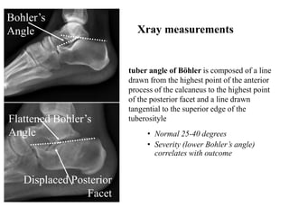Calcaneal fractures | PPT