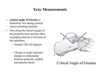Calcaneal fractures | PPT