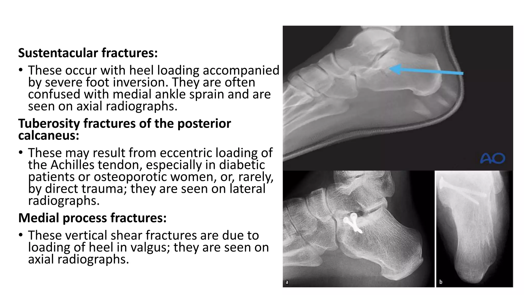 Calcaneal fractures | PDF