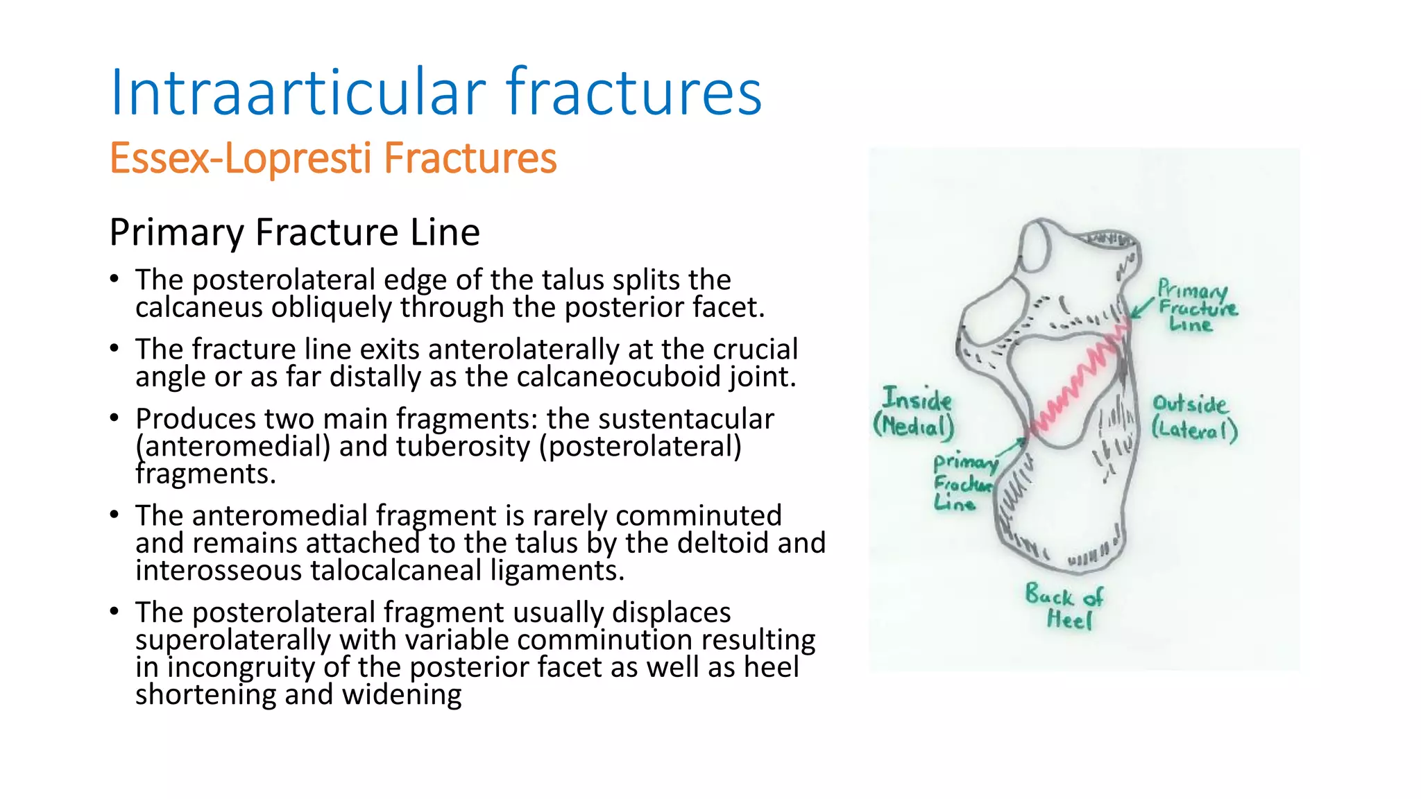 Calcaneal fractures | PDF