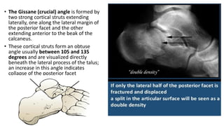 Calcaneal fractures | PDF