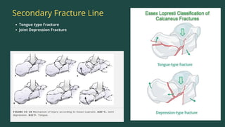 Malunited Calcaneus Fractures | PDF