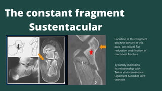 Malunited Calcaneus Fractures | PDF