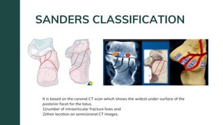 Malunited Calcaneus Fractures | PDF