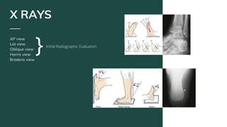 Malunited Calcaneus Fractures | PDF