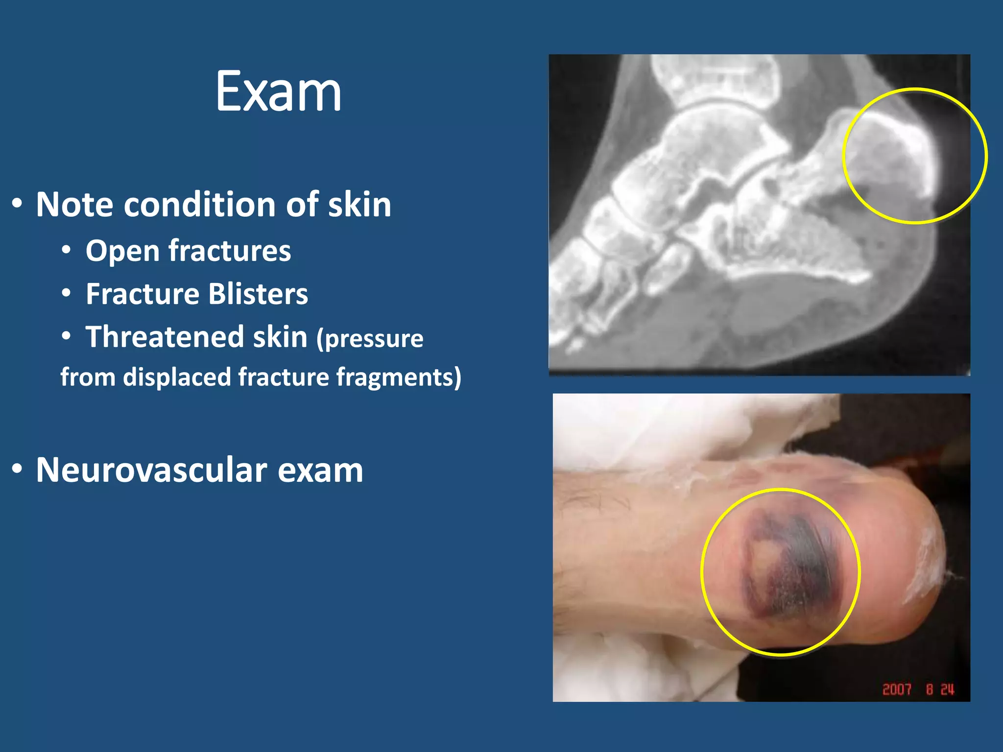 Calcaneal fractures --sito--29th aug 2015 | PPTX