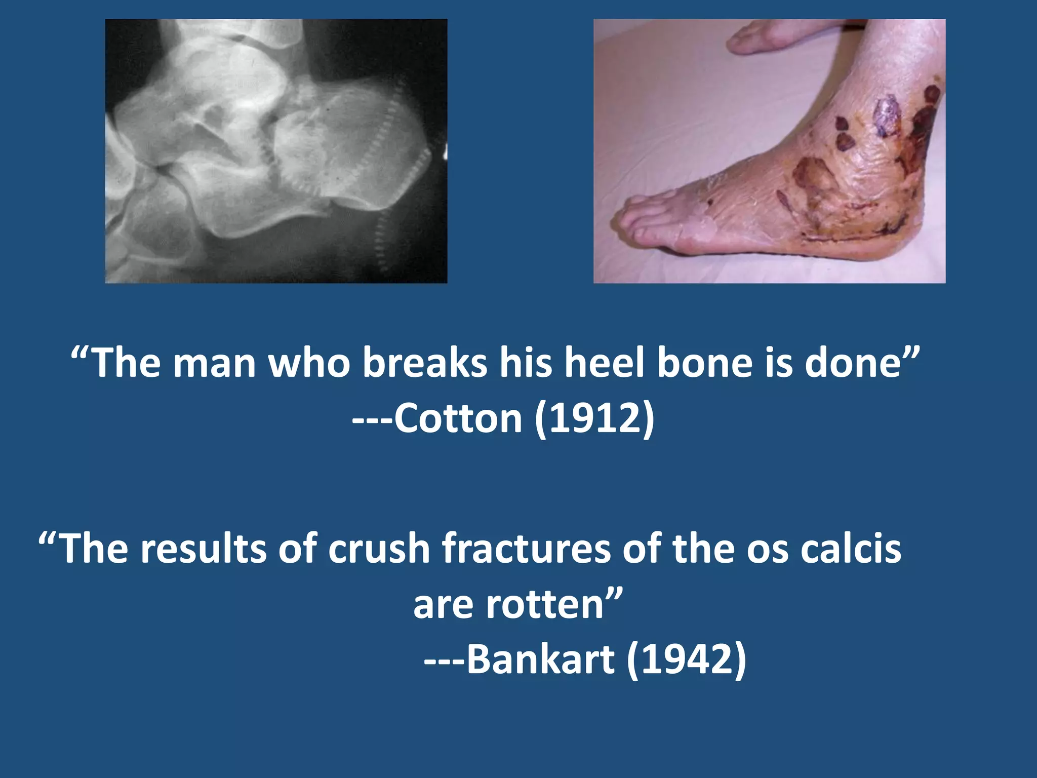 Calcaneal fractures --sito--29th aug 2015 | PPTX