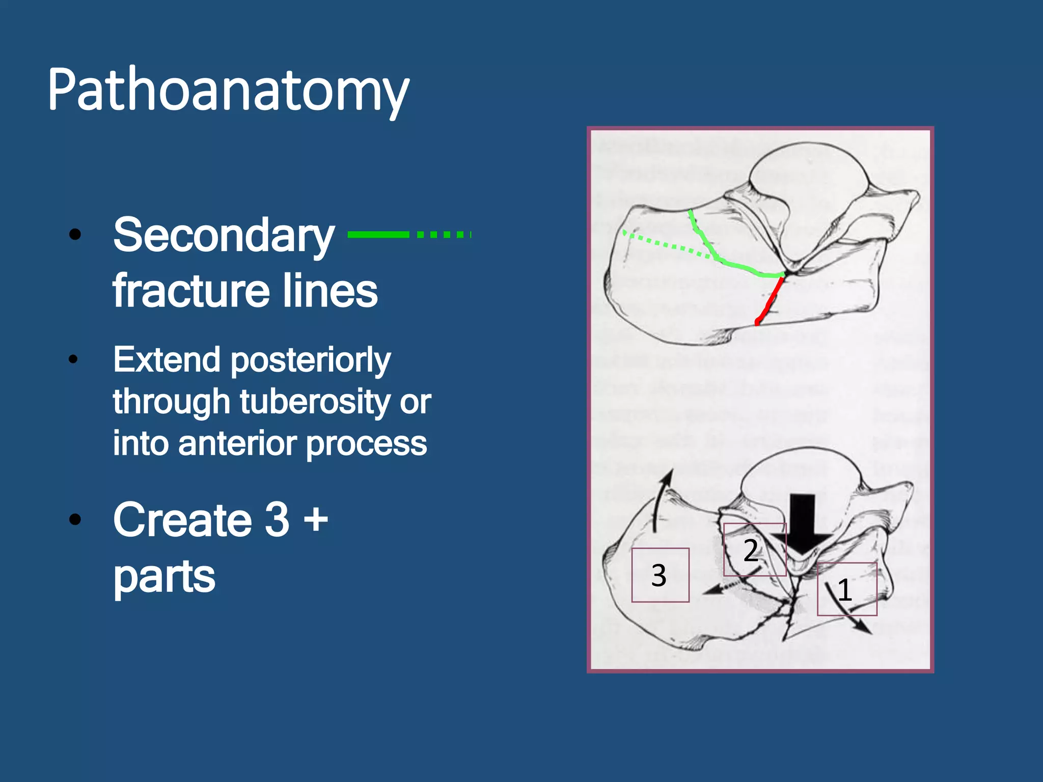 Calcaneal fractures --sito--29th aug 2015 | PPTX